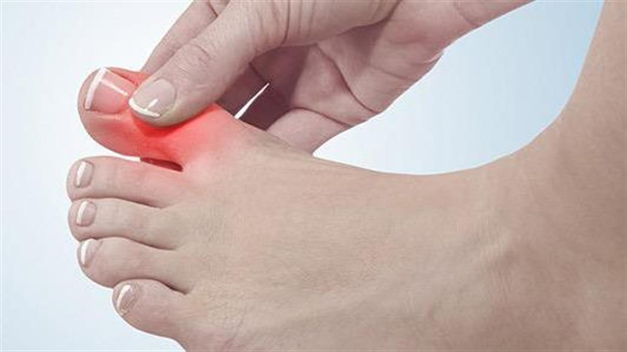 Ουρική αρθρίτιδα: Διάγνωση, επιπλοκές και θεραπεία